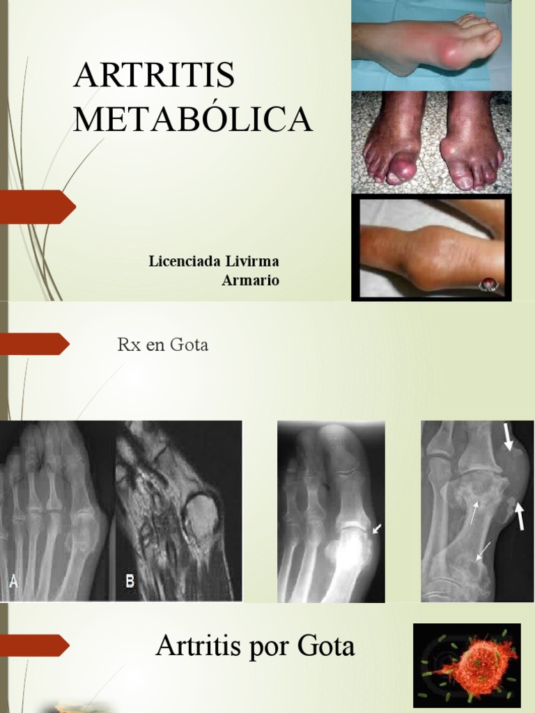 Artritis Gota: Diagnóstico y Manejo | PDF | Gota | Medicina