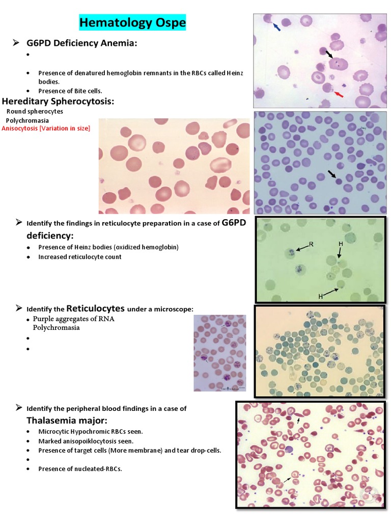Hematology Ospe A1 | PDF | Anemia | Lymphocyte