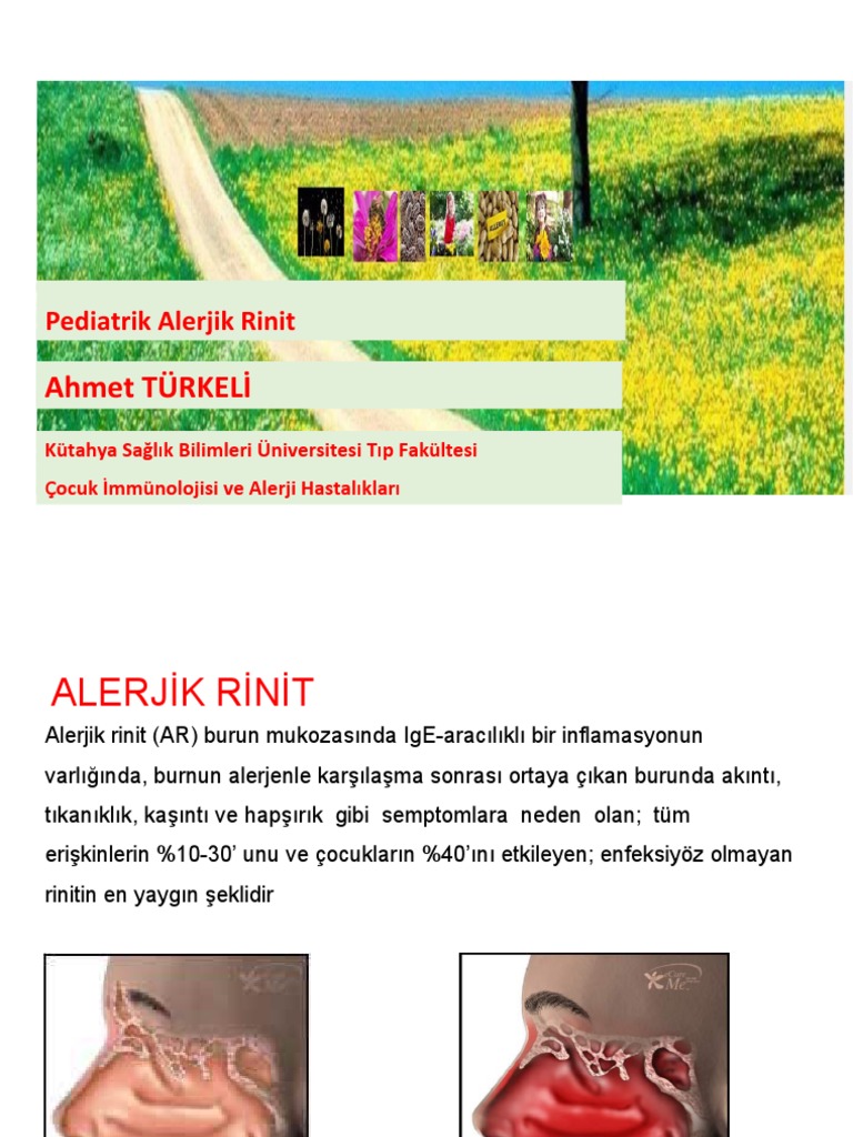 Allerjik Rinit | PDF