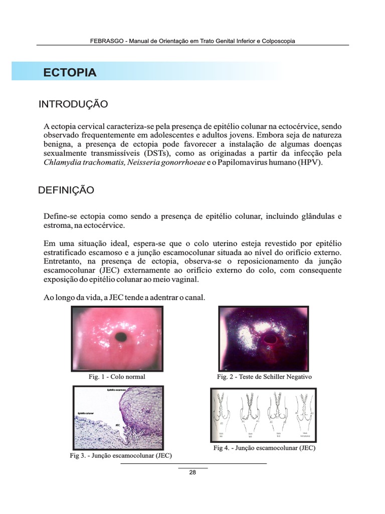 02 Ectopia | PDF | Câncer cervical | Ciências da Saúde