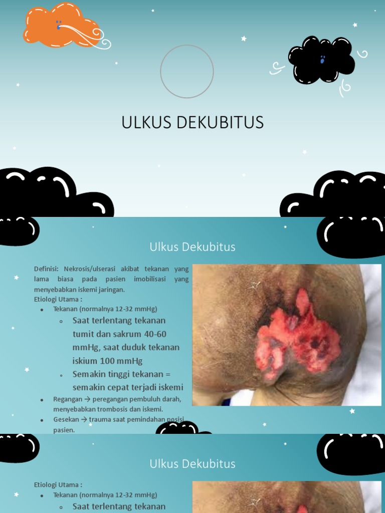 Ulkus Dekubitus | PDF