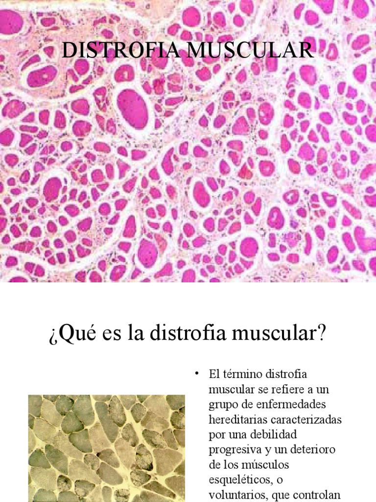 Distrofias Musculares | PDF