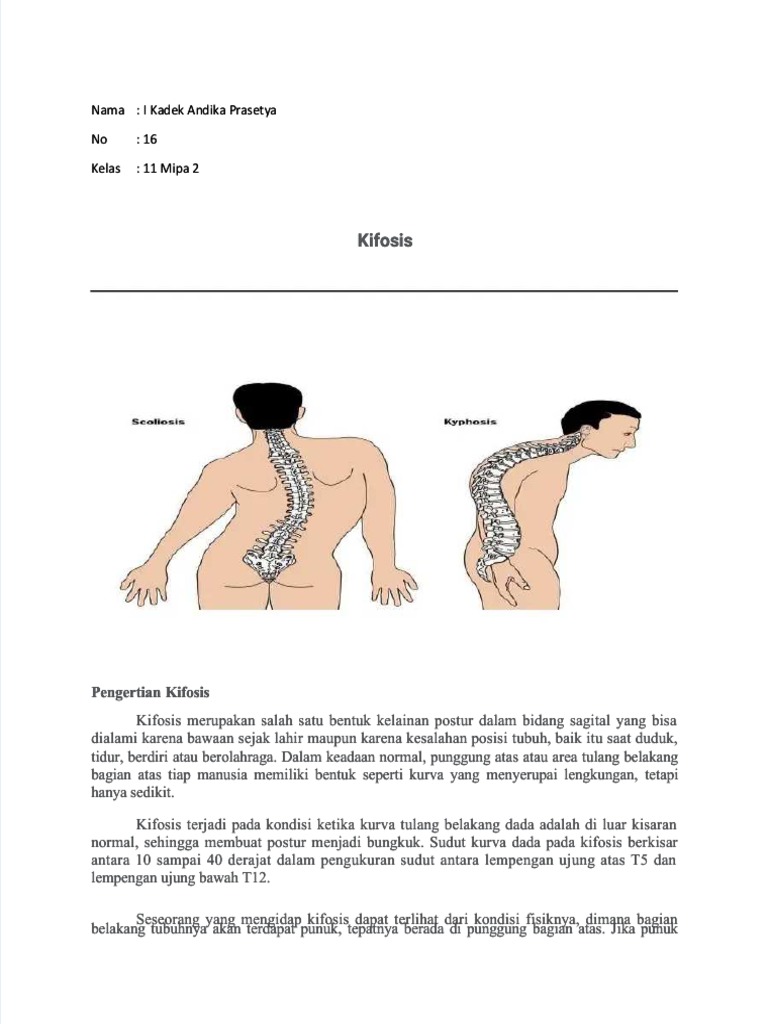 Pdf-Kifosis Compress | PDF