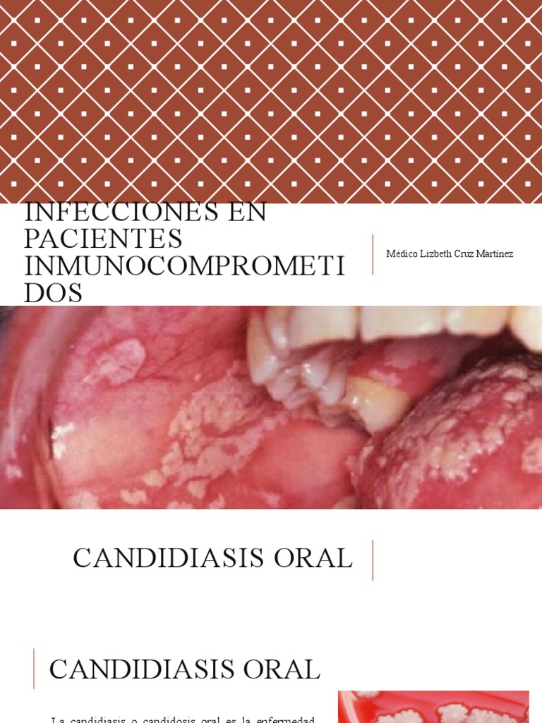 Candidiasis Oral | PDF