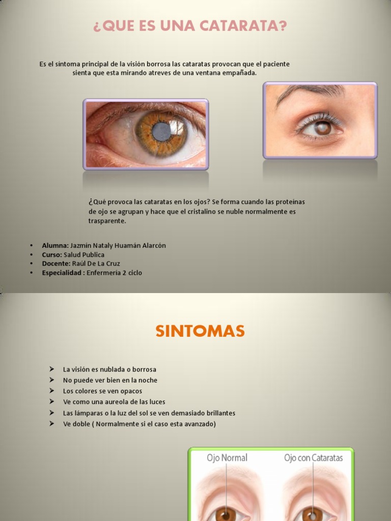 Síntomas y tratamiento de cataratas | PDF | Salud y bienestar | Ciencia ...