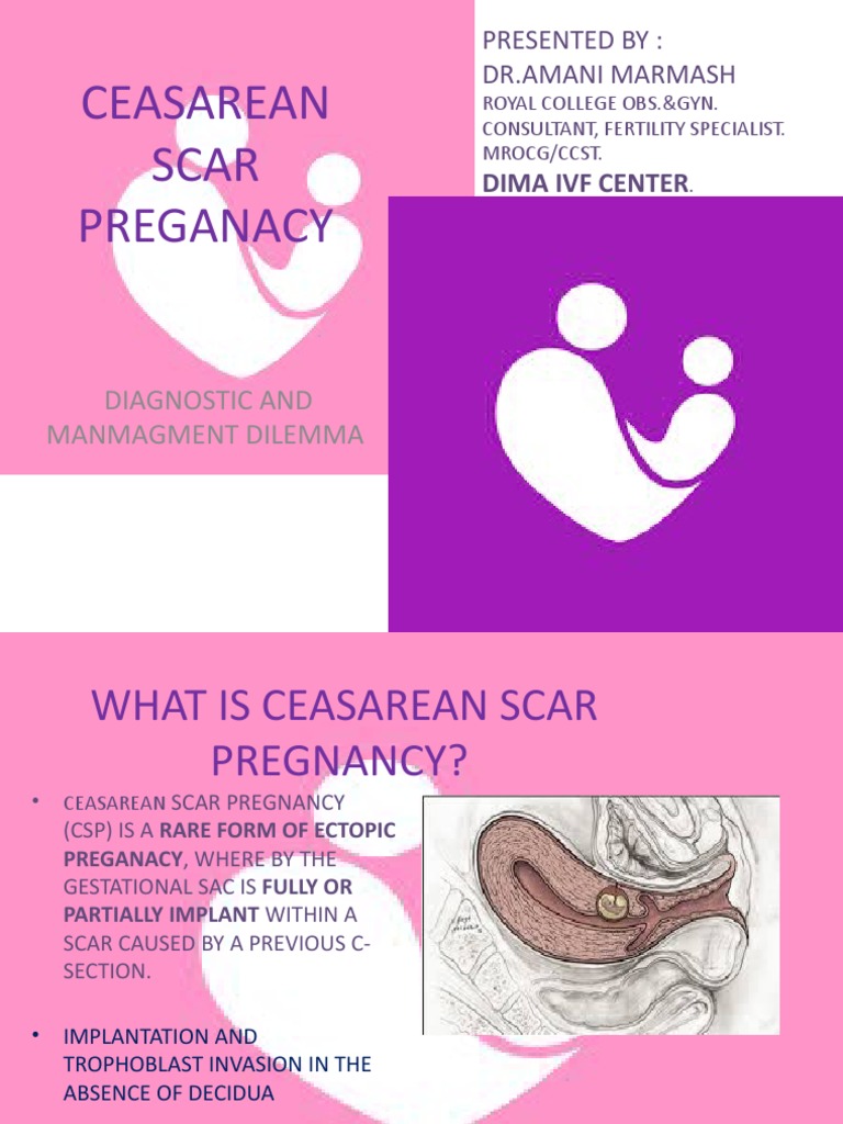 Caesarean Scar Pregnancy Guide | PDF | Uterus | Caesarean Section