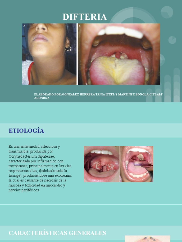 Características y tratamiento de la difteria | PDF | Resfriado comun ...
