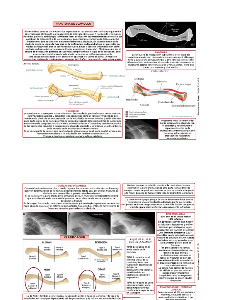 Fractura de Clavicula | PDF | Hombro | Hueso