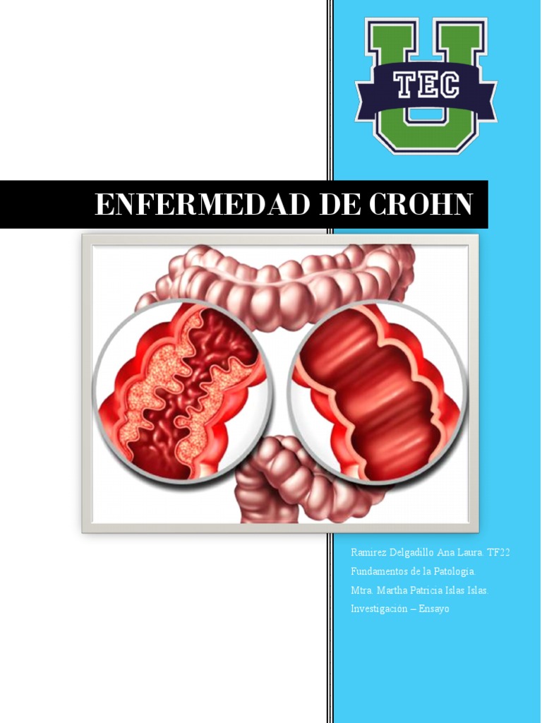 Enfermedad de Crohn | PDF | Enfermedad de Crohn | Intestino grueso