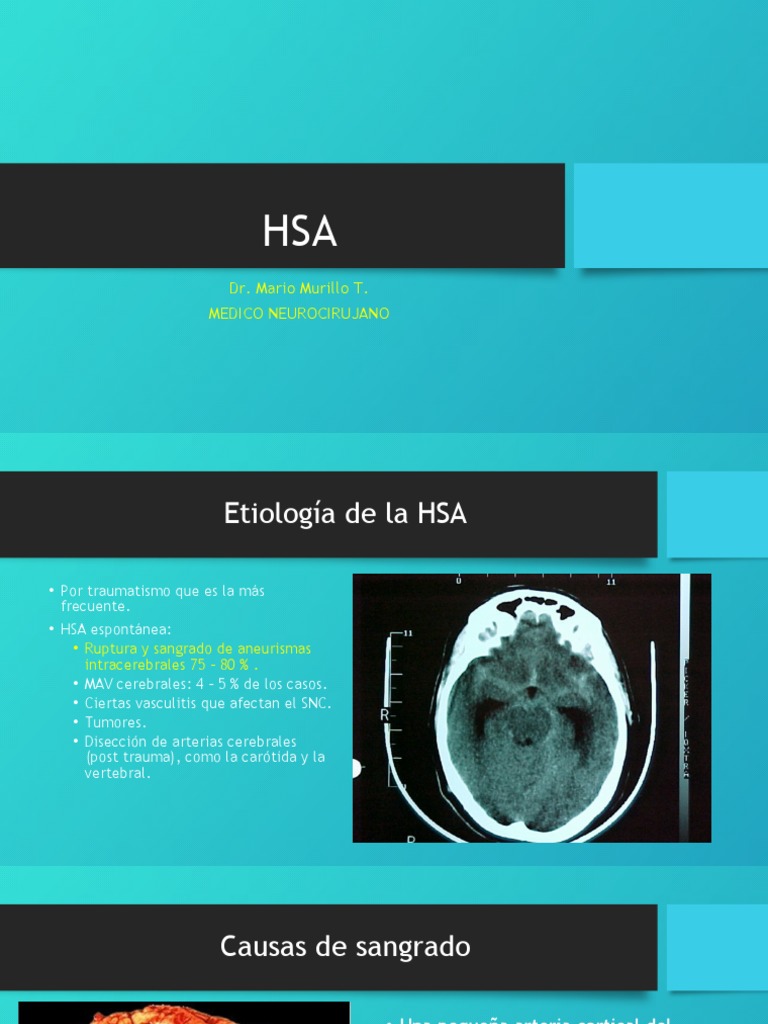 Hemorragia Subaracnoidea | PDF