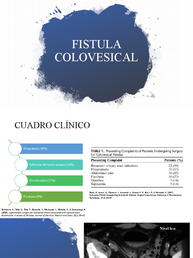 Síntomas y Tratamiento de Fístula Colovesical | PDF | Especialidades ...