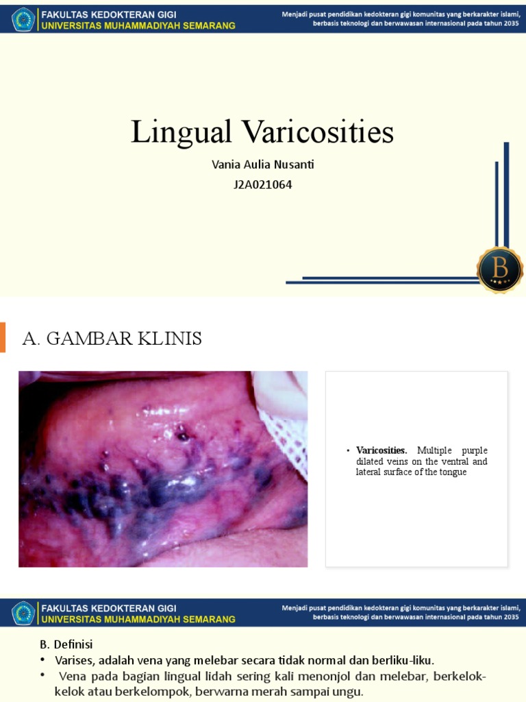 Lingual Varicosities | PDF