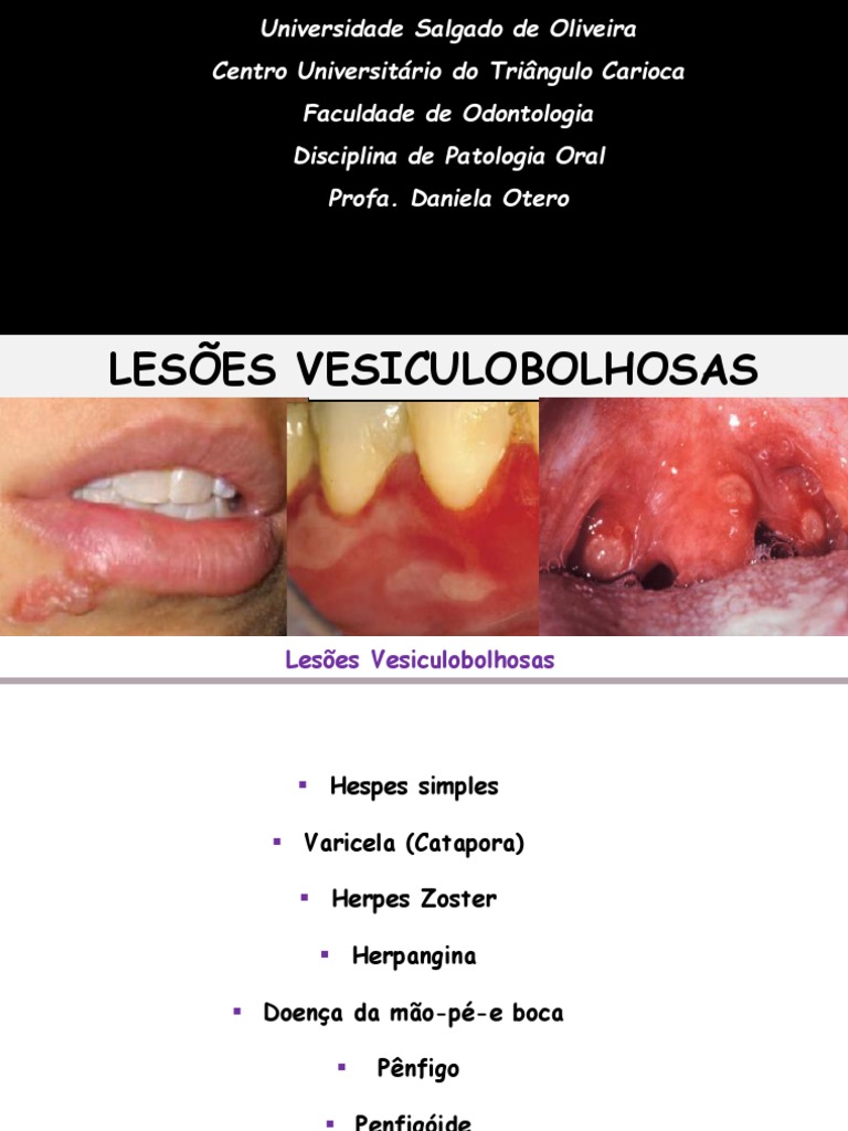 Aula de Lesões Vesiculobolhosas | PDF