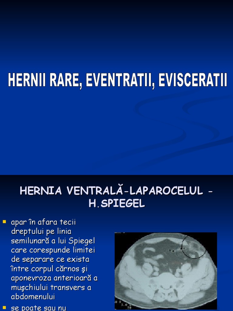 Hernia 3 | PDF
