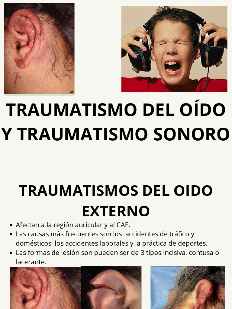 Traumatismo Sonoro Agudo | PDF | Oído | Lesión