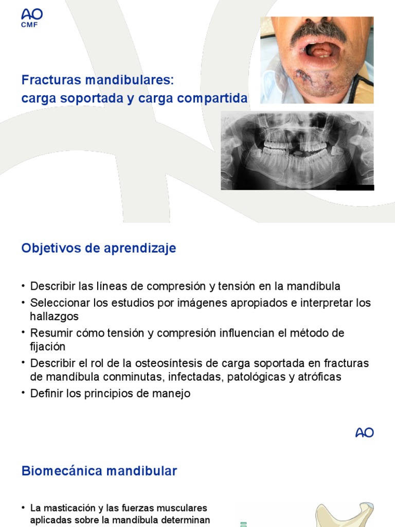 Fracturas Mandibulares: Carga y Manejo | PDF | Hueso | Fractura