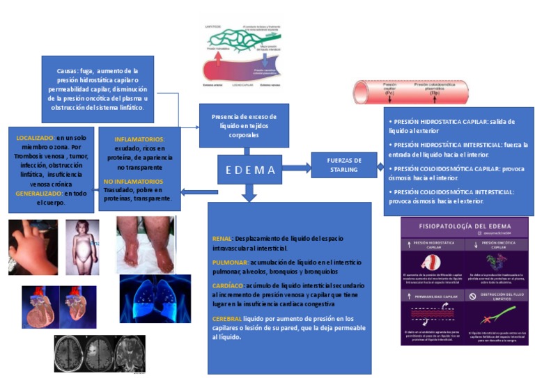Mapa Mental del Edema Cardiaco | PDF