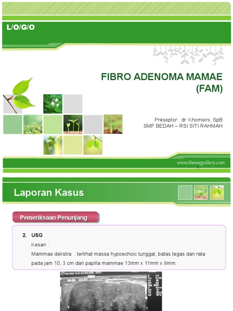 Fibro Adenoma Mamae (Fam) | PDF