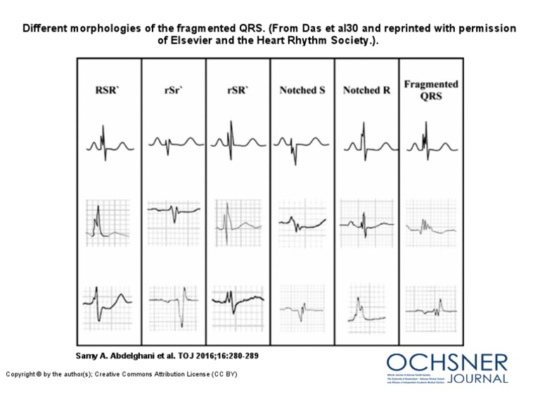 Different Morphologies of The Fragmented QRS. (From Das Et Al30 and ...