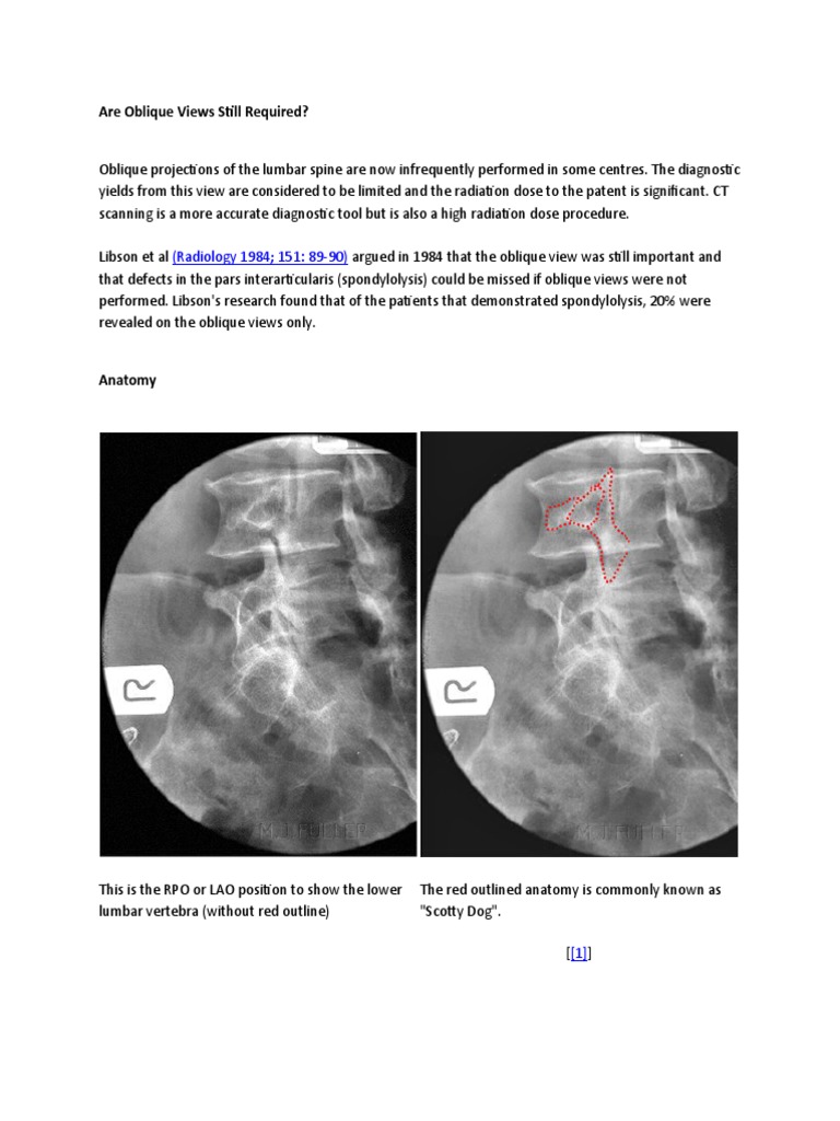 Oblique View Of Lumbar Spine