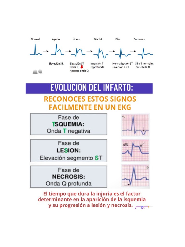 Tipos Infarto | PDF