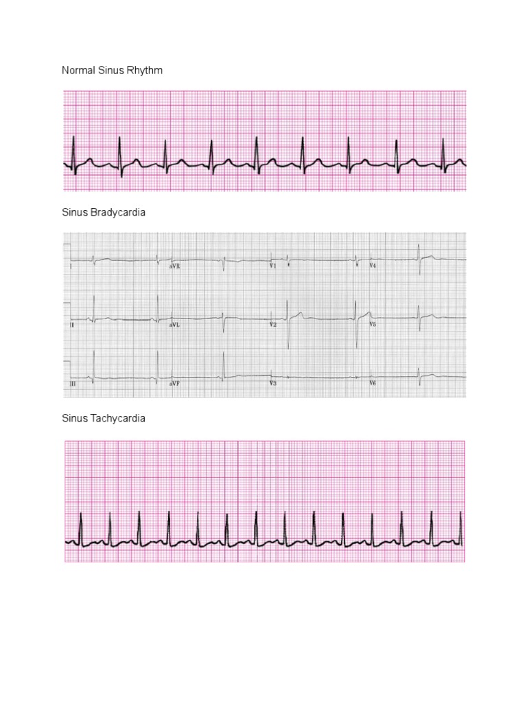 Ekg Strips | PDF