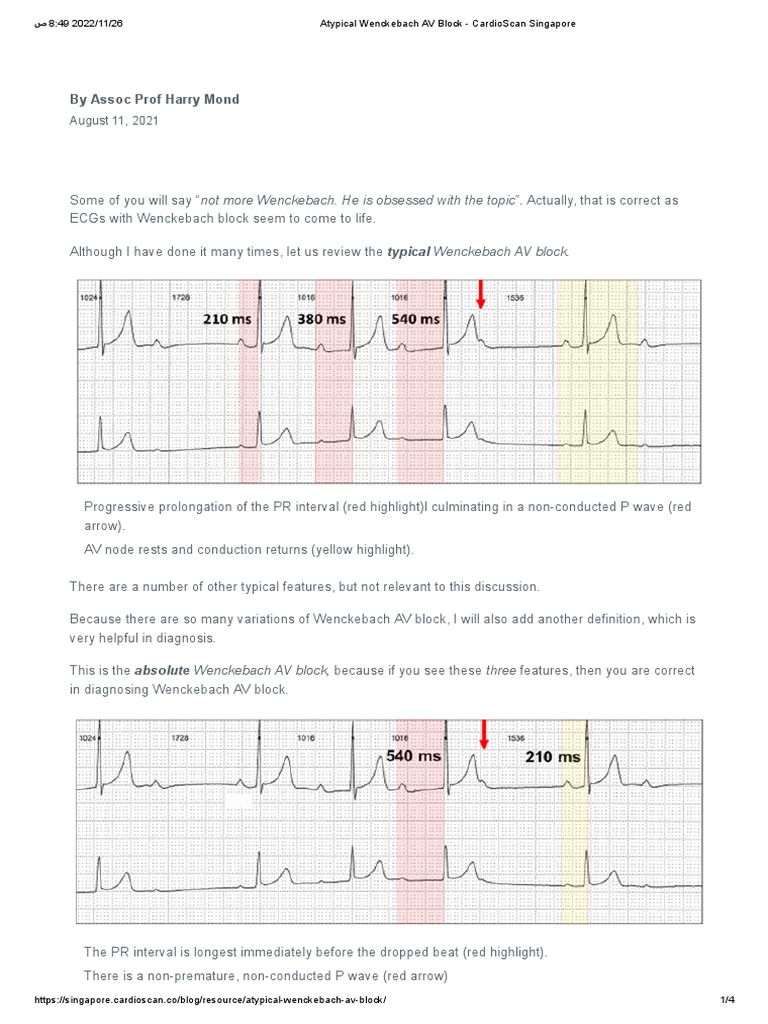 Atypical Wenckebach AV Block - CardioScan Singapore | PDF