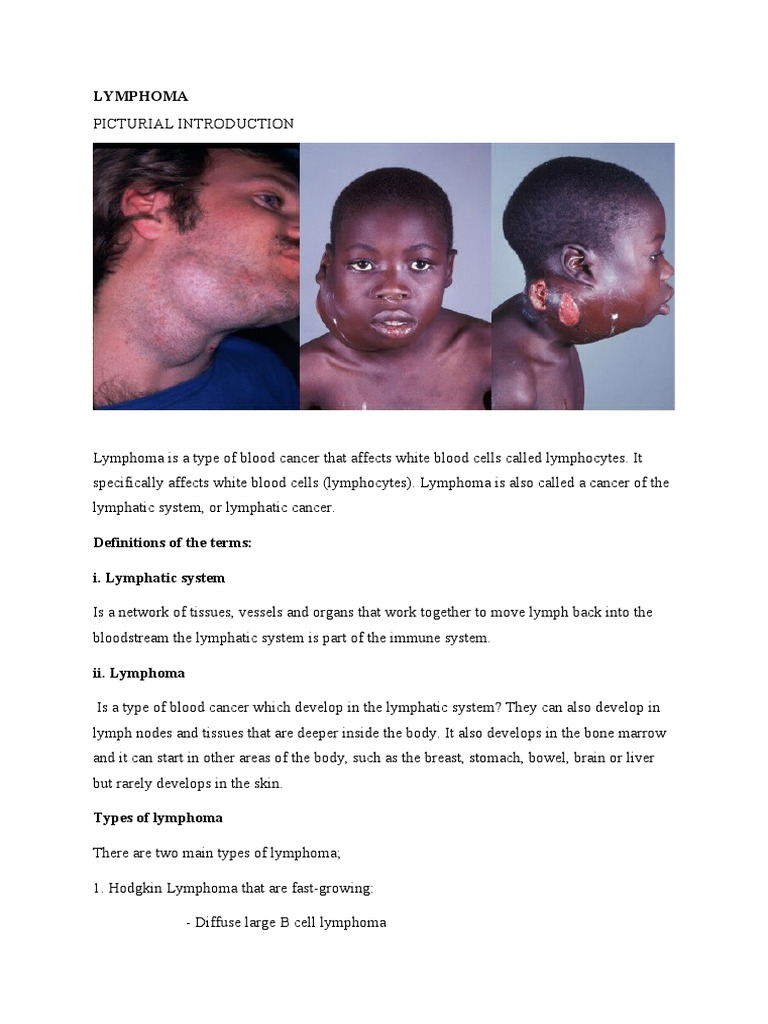 Lyphoma | PDF | Lymphoma | Lymphatic System