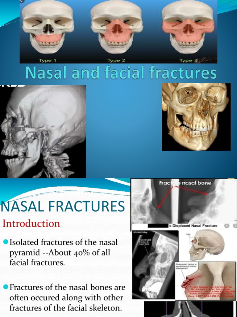 Nasal and Facial Fractures | PDF | Human Nose | Clinical Medicine