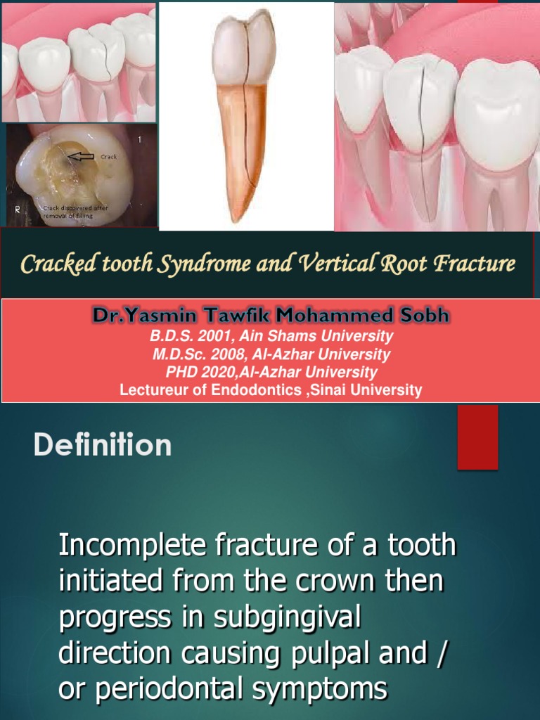 Cracked Tooth Syndrome and Vertical Root Fracture 2 1 1 | PDF ...