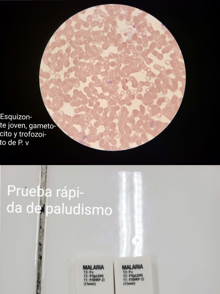 Malaria 2 | PDF
