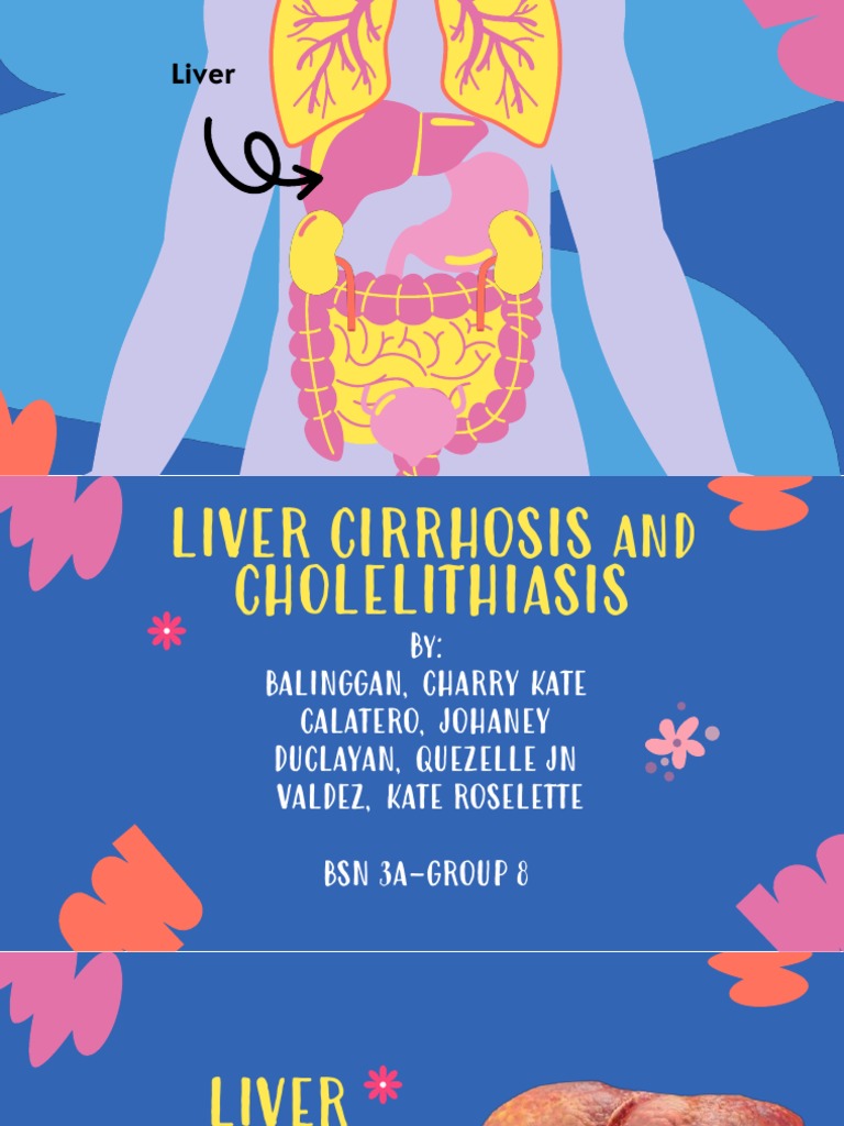 Cholelithiasis and Liver Cirrhosis | PDF | Cirrhosis | Liver