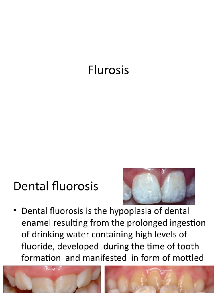 Fluorosis | PDF