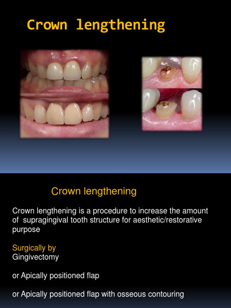 Crown Lengthening | PDF | Dentistry Branches | Dentistry