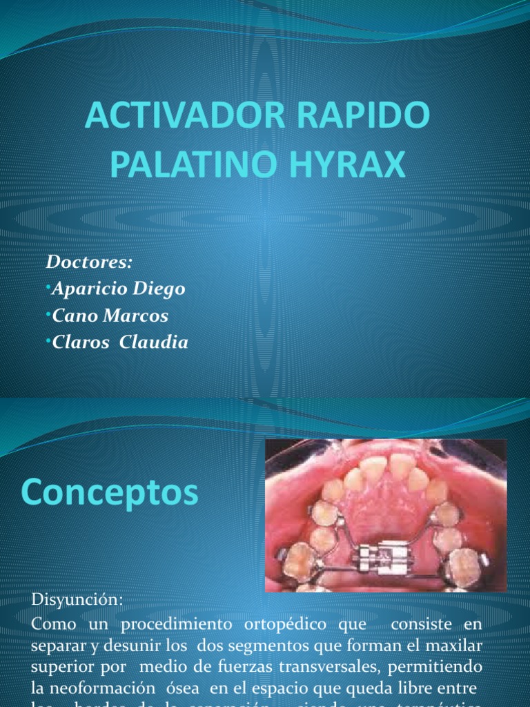 Activador Rapido Palatino Hyrax | PDF