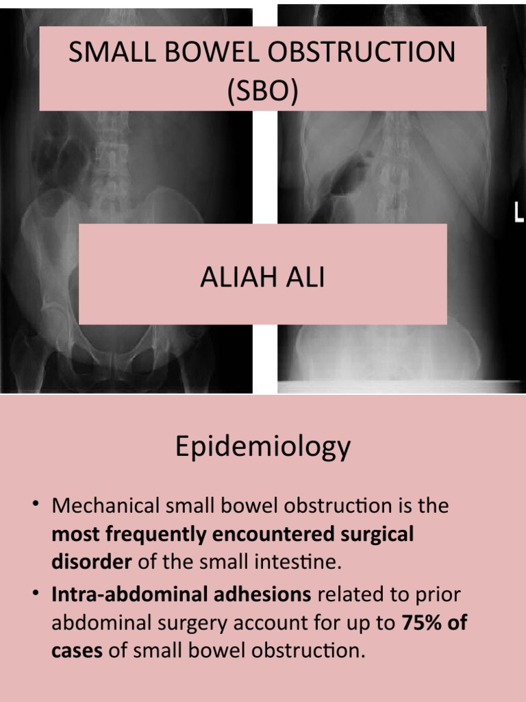Sbo Presentation | PDF | Digestive Diseases | Epidemiology