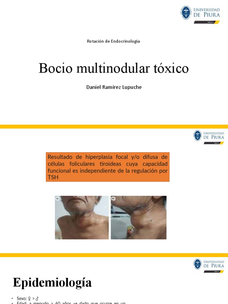 Bocio Multinodular Tóxico | PDF | Salud y bienestar