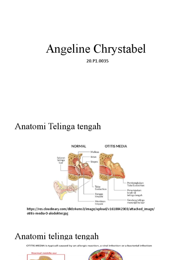 Angeline Chrystabel - Otitis Media Akut - 20p10035 | PDF
