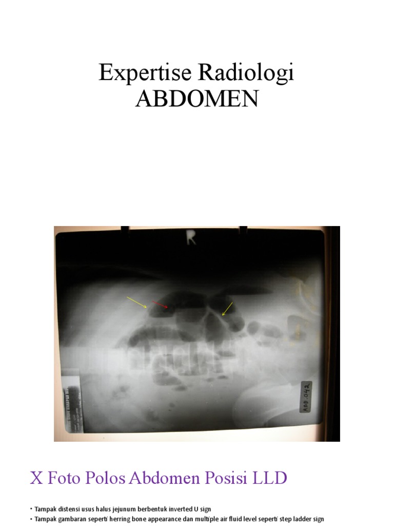 Expertise Radiologi Abdomen Dan HSG | PDF