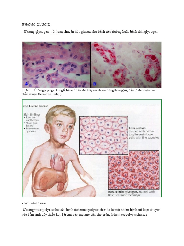 Ứ ĐỌNG GLUCID | PDF