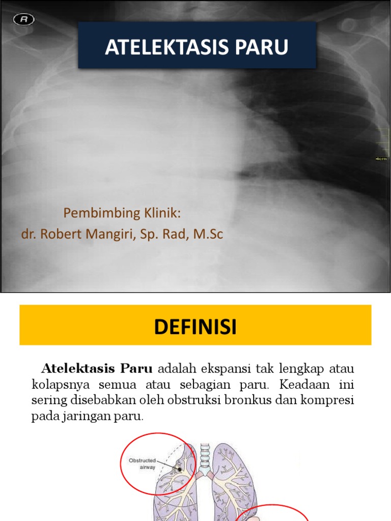 Atelektasis Paru: Definisi dan Diagnosis | PDF