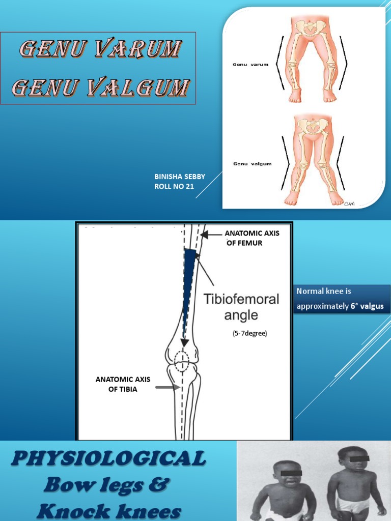 Genu Valgum Varum | Download Free PDF | Knee | Joints