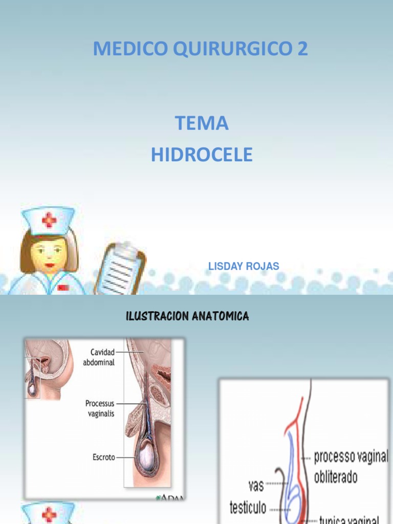 Hidrocele y Clasificacion