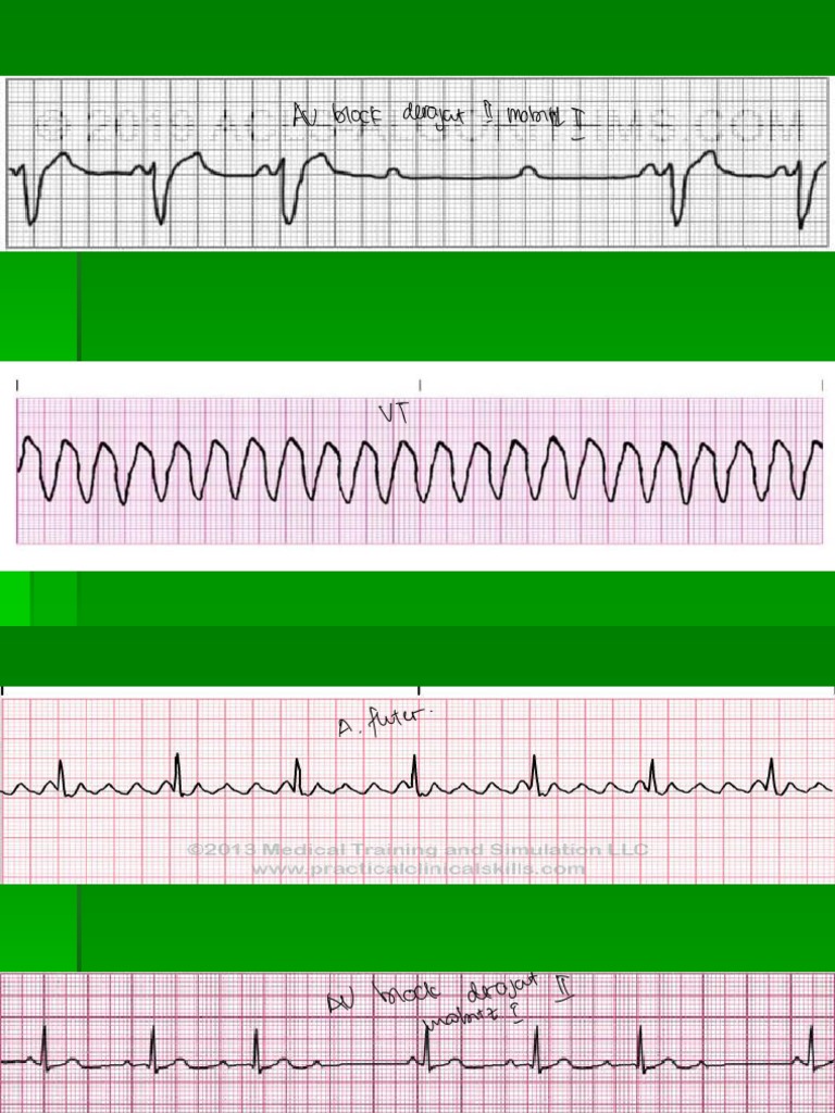 Aritmia Acls Soal Ecg | PDF