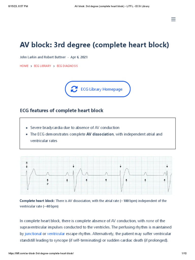Complete Heart Block ECG Overview | PDF | Wellness | Science & Mathematics