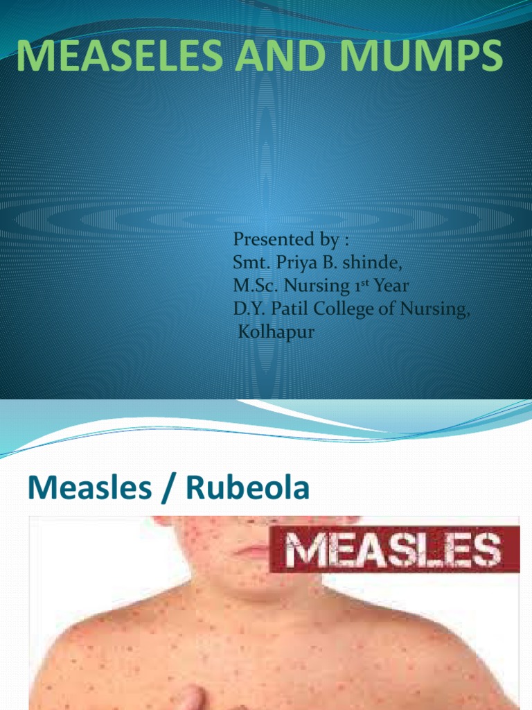Measeles and Mumps Ppt | PDF