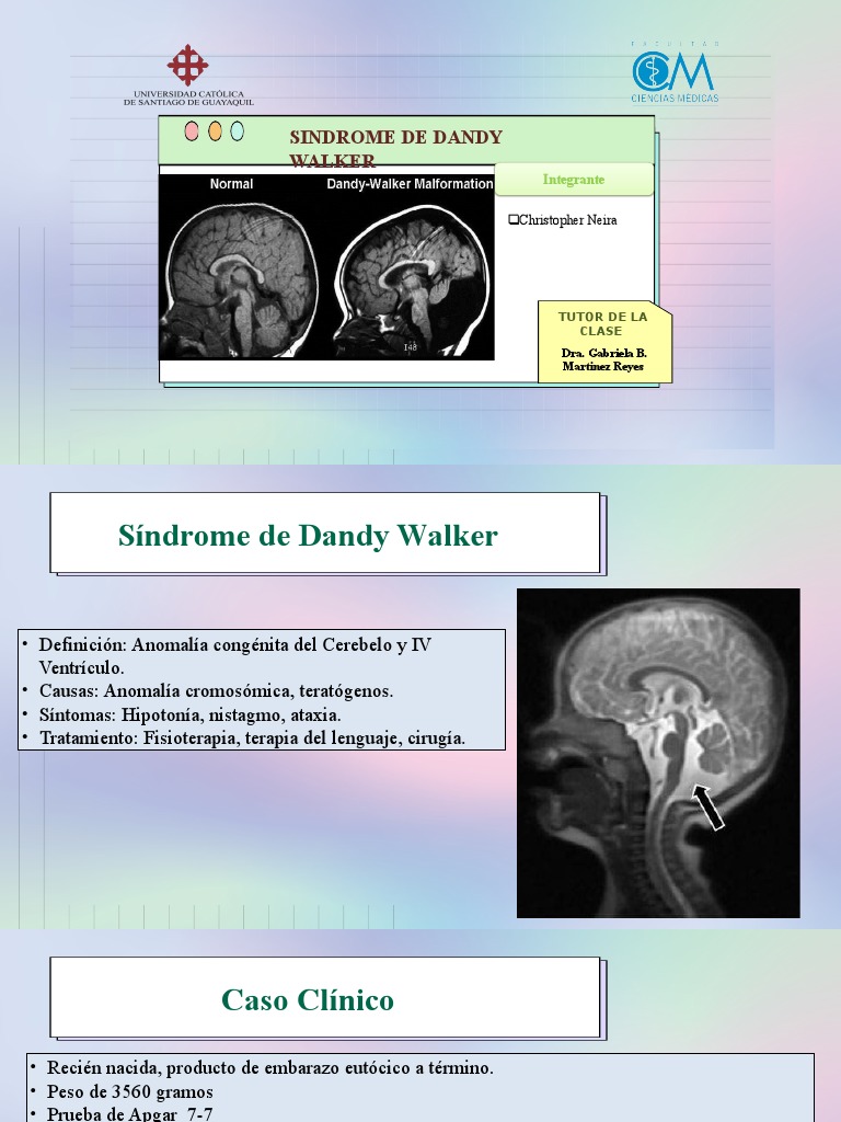 Dandy Walker | PDF | Epidemiología | Sistema nervioso