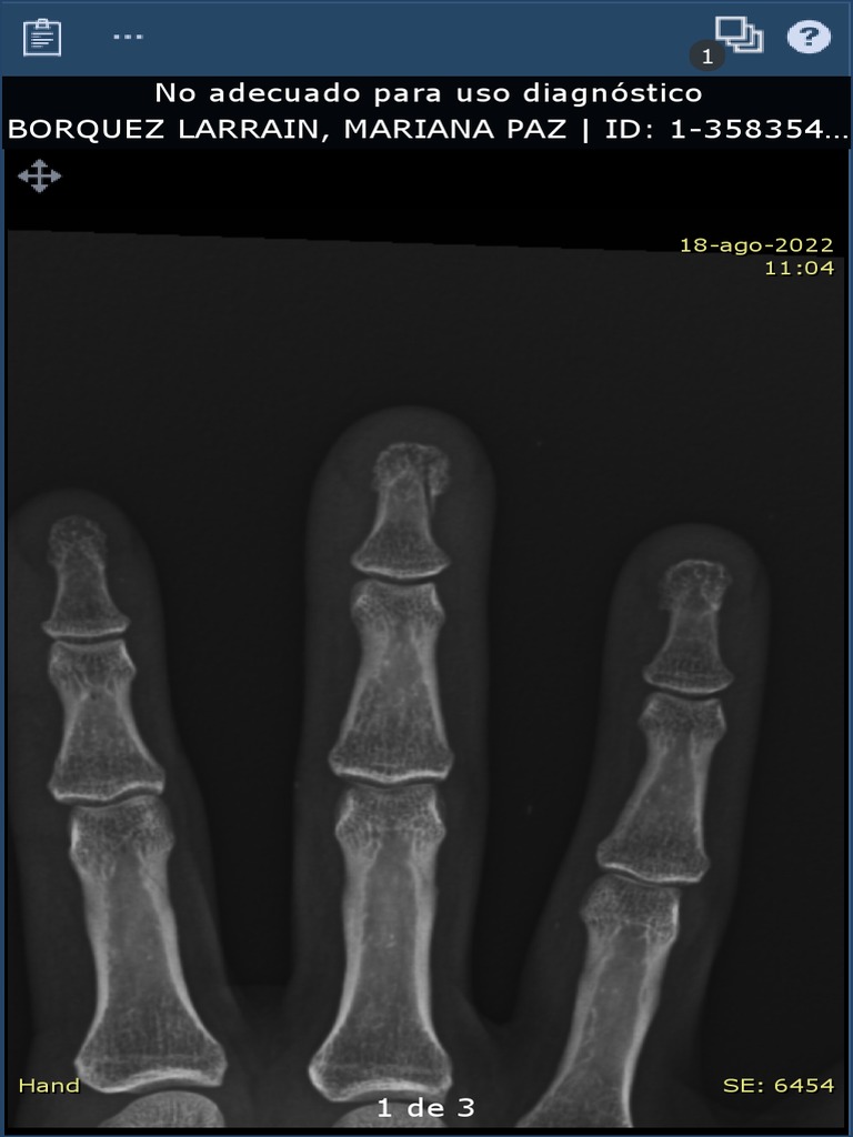 Fractura de dedo | PDF