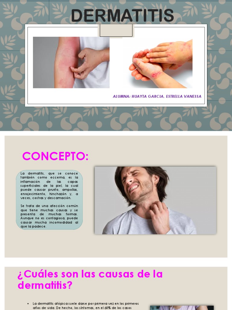 Dermatitis | PDF | Alergia | Medicina CLINICA
