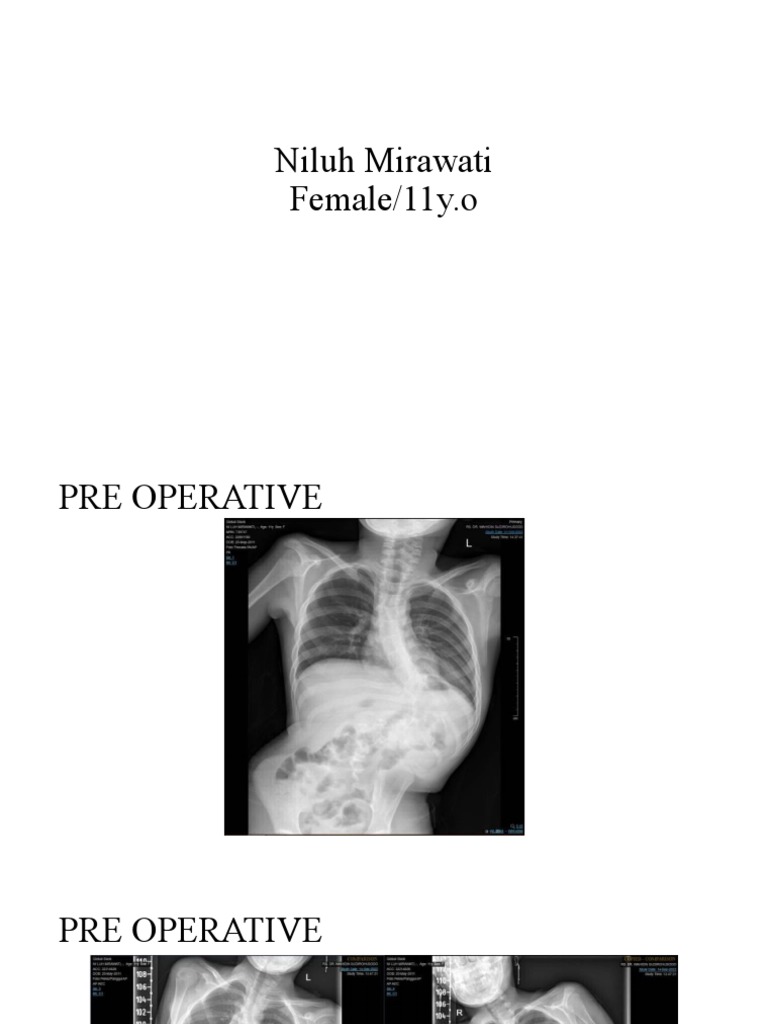 POST OP SPINE Niluh BN | PDF | Epidemiology | Medical Specialties